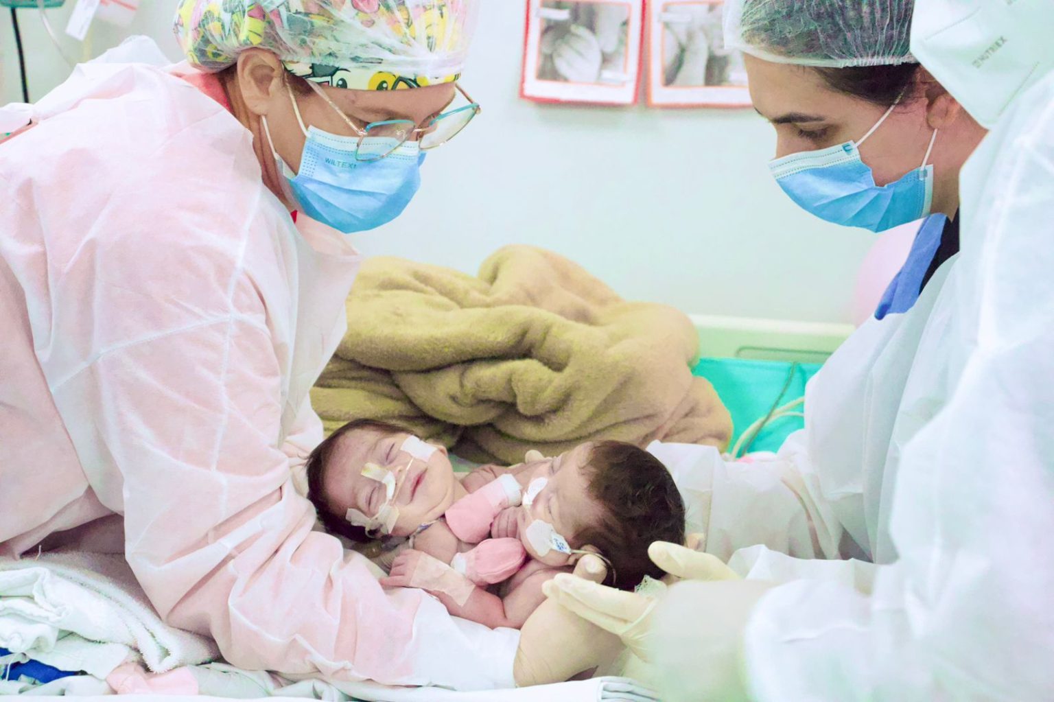 Gêmeas siamesas nascidas em Manaus são separadas com sucesso em Goiás ...